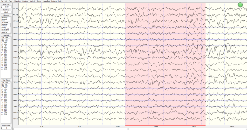 QEEG Brain Mapping Colorado Springs - Neuro Hope Neurofeedback
